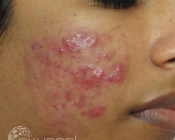 Post Inflammatory Hyperpigmentation (PIH) - Oxypeel Advanced Skincare ...