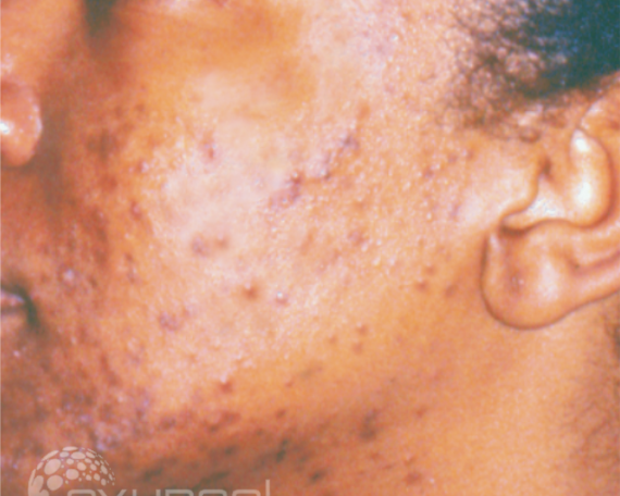 Post Inflammatory Hyperpigmentation (PIH) - Oxypeel Advanced Skincare ...