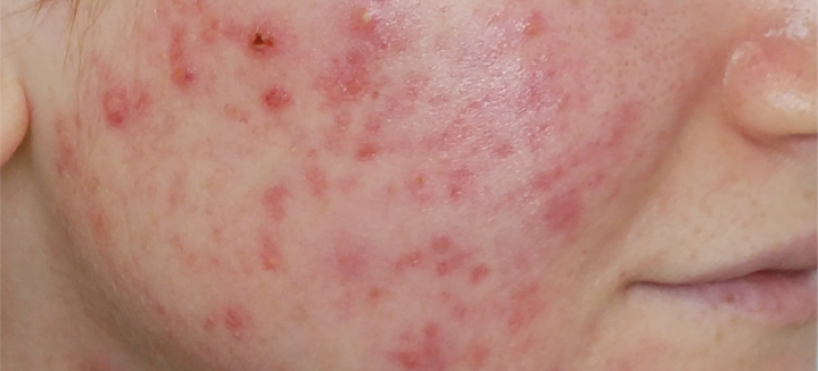 Post Inflammatory Hyperpigmentation (PIH) - Oxypeel Advanced Skincare ...