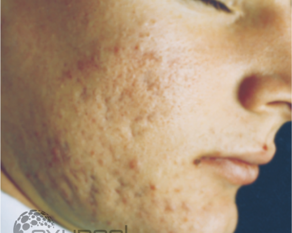 Post Inflammatory Hyperpigmentation (PIH) - Oxypeel Advanced Skincare ...